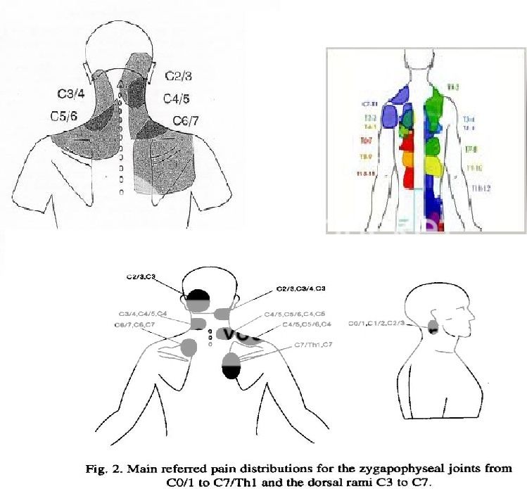 Midline interscapular pain | Student Doctor Network Forums
